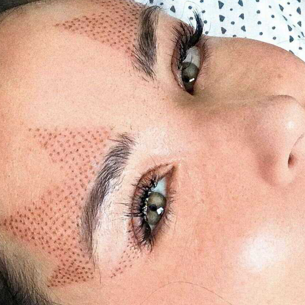 Fibroblast Treatment Area: Brow Lift – Faces by Jennifer | Faces by ...